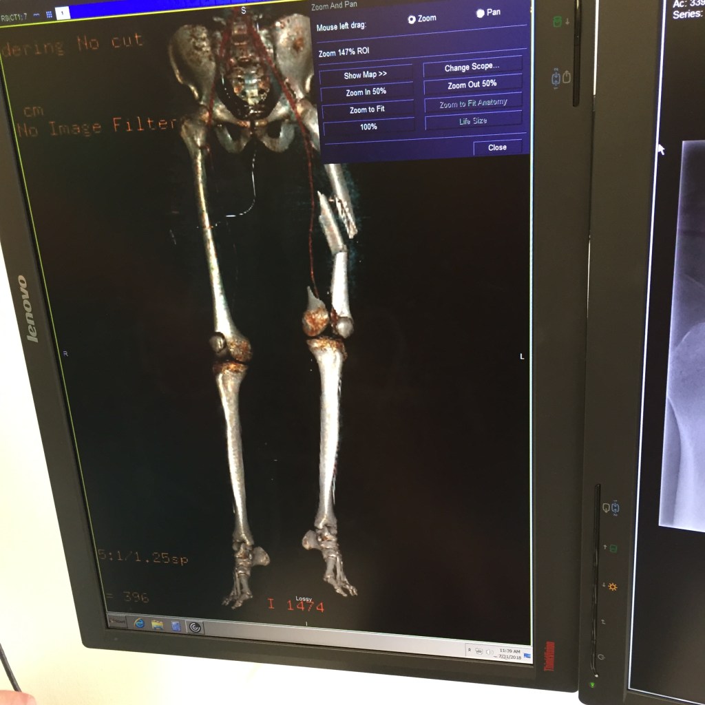 What a Difference for Hayden Mobley! | Encore Rehabilitation, Inc.